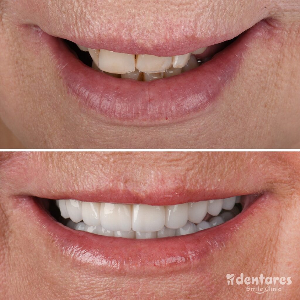 Get your teeth done in turkey | Dentares Dental Centre Turkey