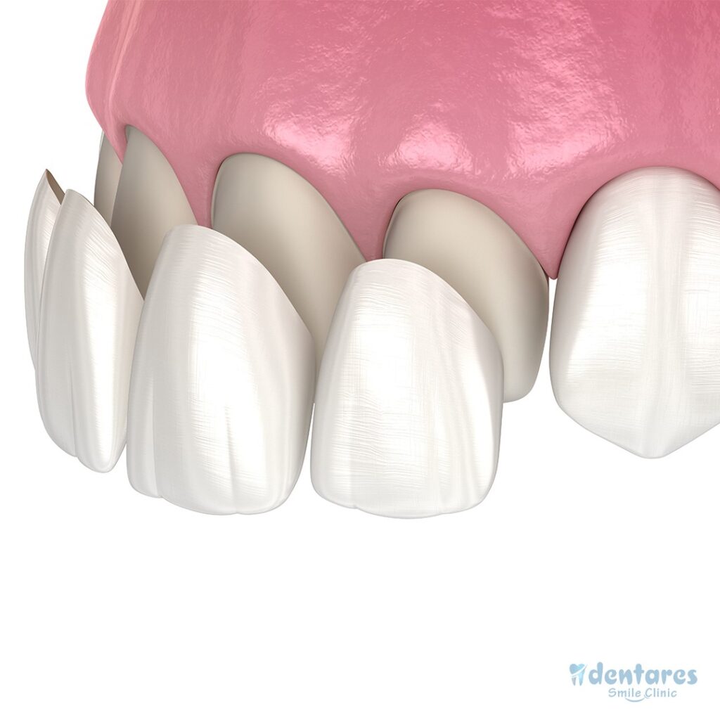 Full Set Of Veneers In Turkey | Dentares Dental Centre Turkey
