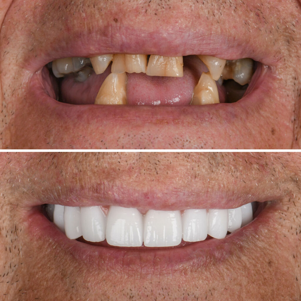 Inlay/ Onlay Restorations | Dentares Dental Centre Turkey