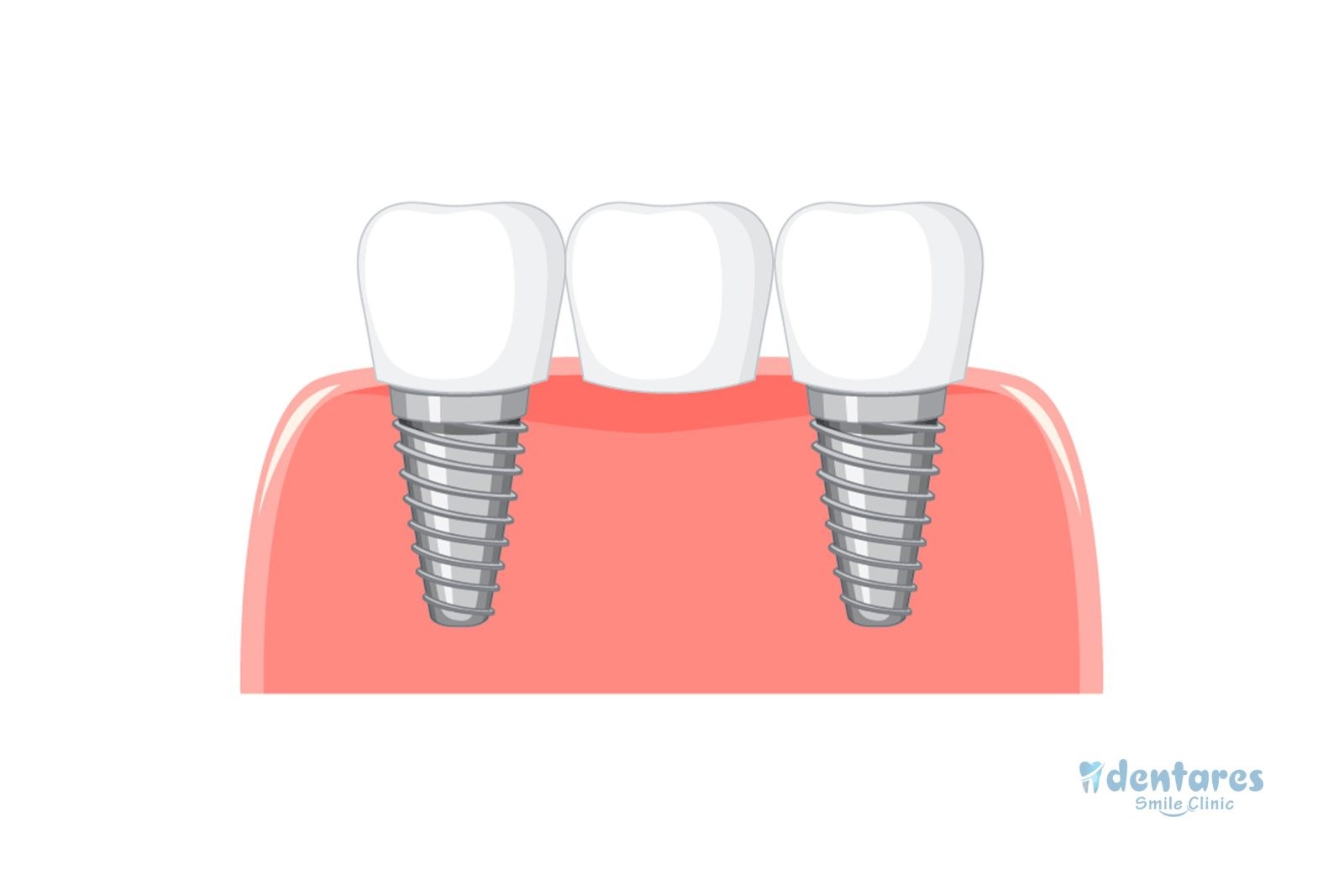 Get the best dental bridges at DentaresSmile.